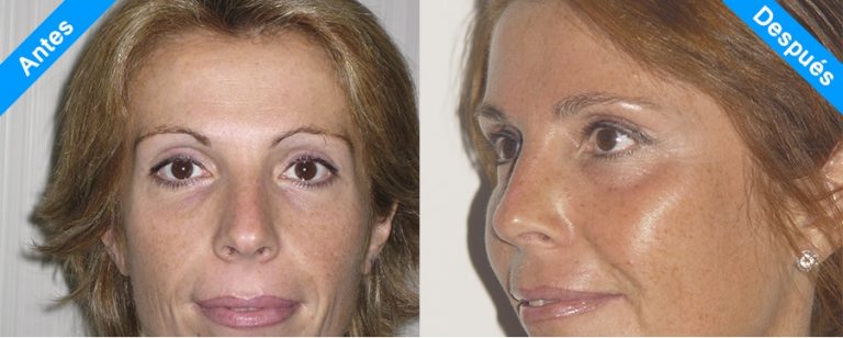 lifting facial 2 - Blog de Masquemedicos