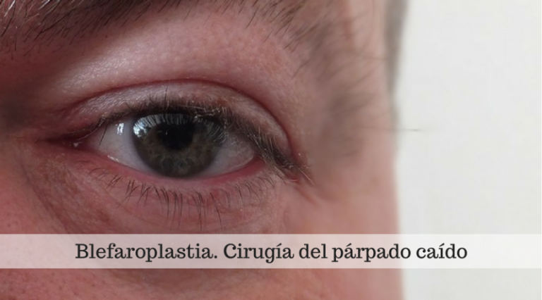 Blefaroplastia Cirugía Del Párpado Caído Blog De Masquemedicos