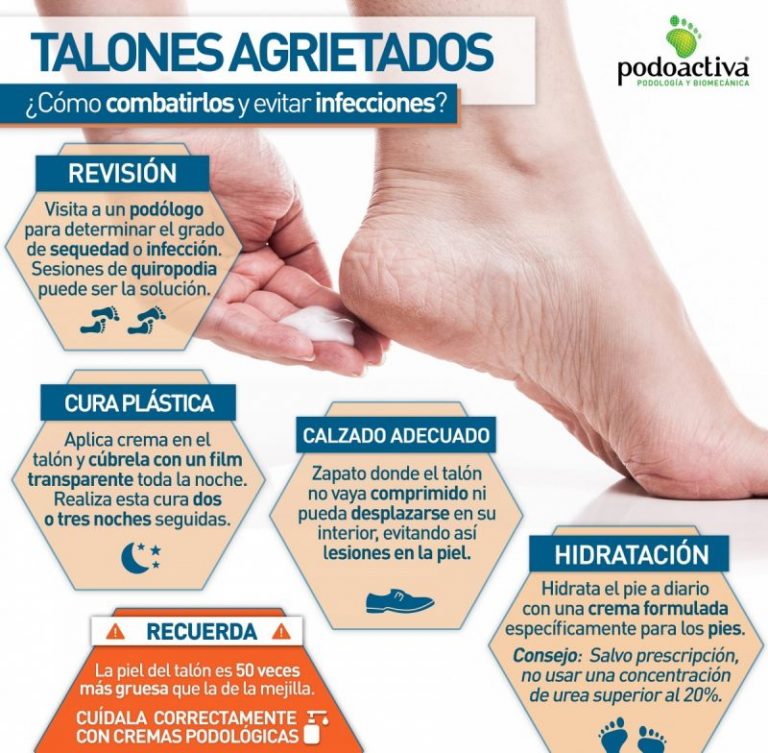 Talones agrietados: causas y soluciones - Blog de Masquemedicos