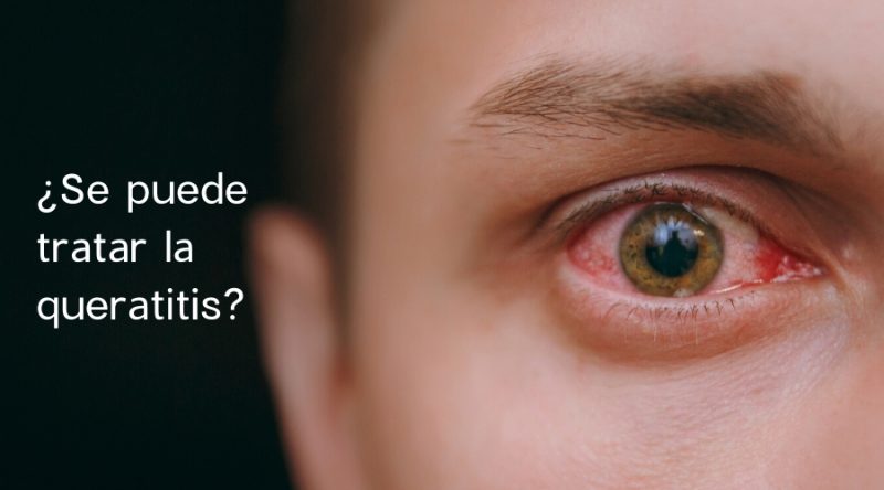 ¿Se puede tratar la queratitis? - Blog de Masquemedicos
